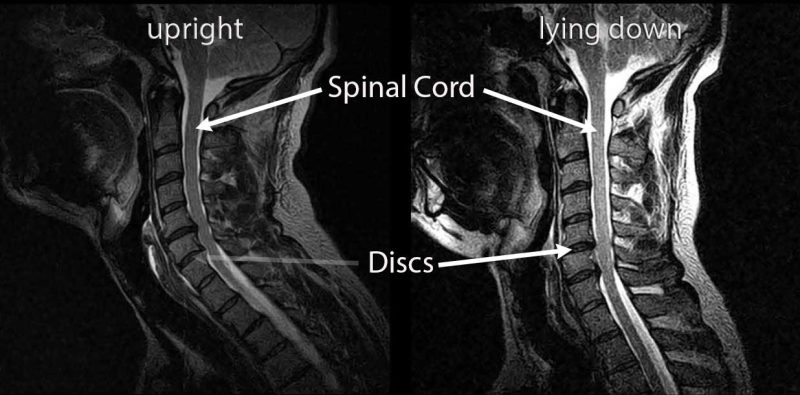 Spinal Cord Compression While Upright